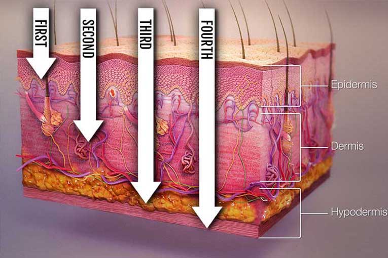 What is a Fourth Degree Burn?